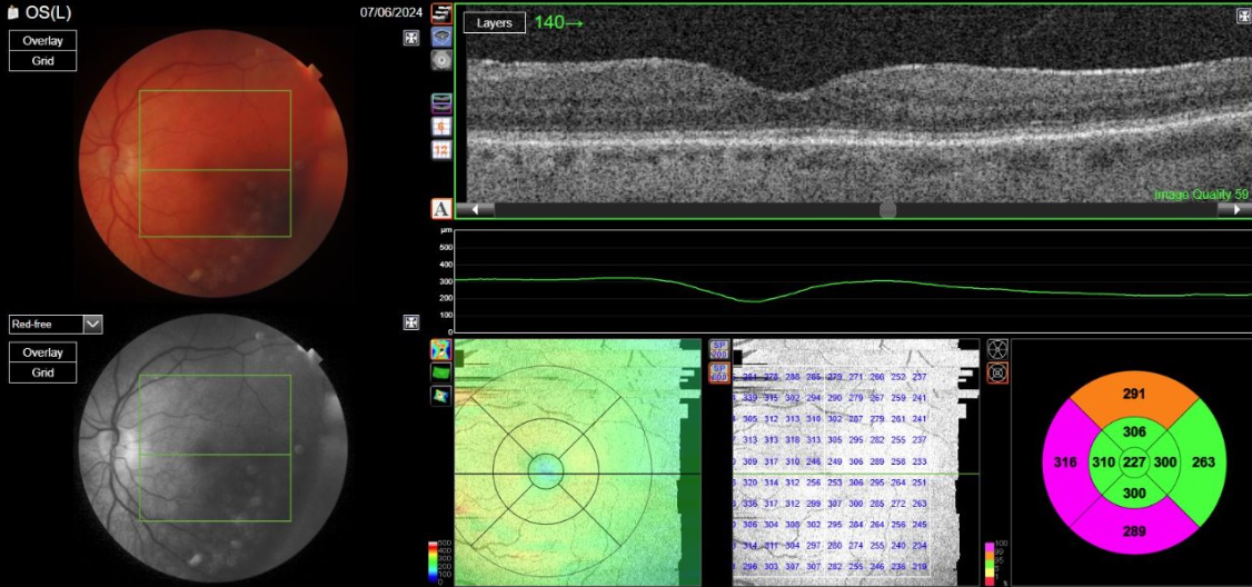 Post-op cystoid macula odema - Scope Connect