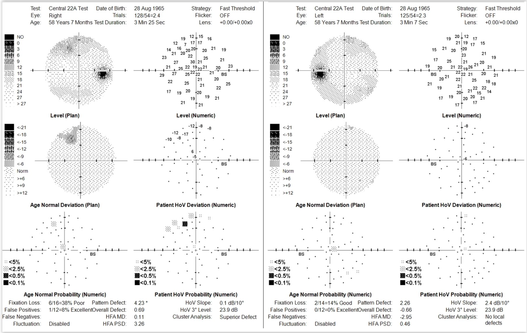 Bilateral pigment dispersion glaucoma - Scope Connect