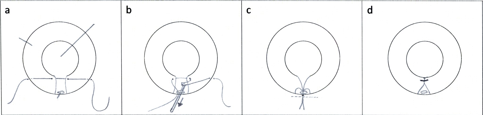 When cataract surgery goes wrong - Scope Connect
