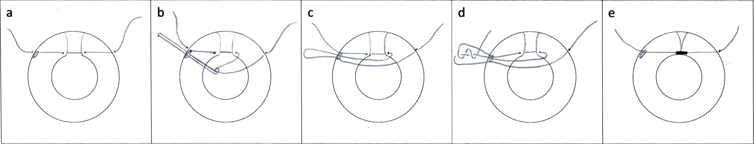 When cataract surgery goes wrong - Scope Connect