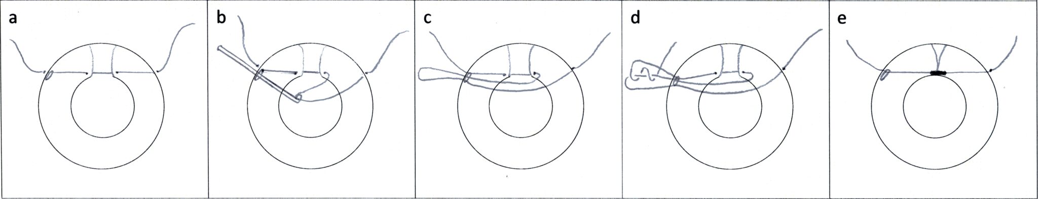 When cataract surgery goes wrong - Scope Connect
