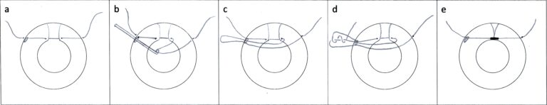 When cataract surgery goes wrong - Scope Connect