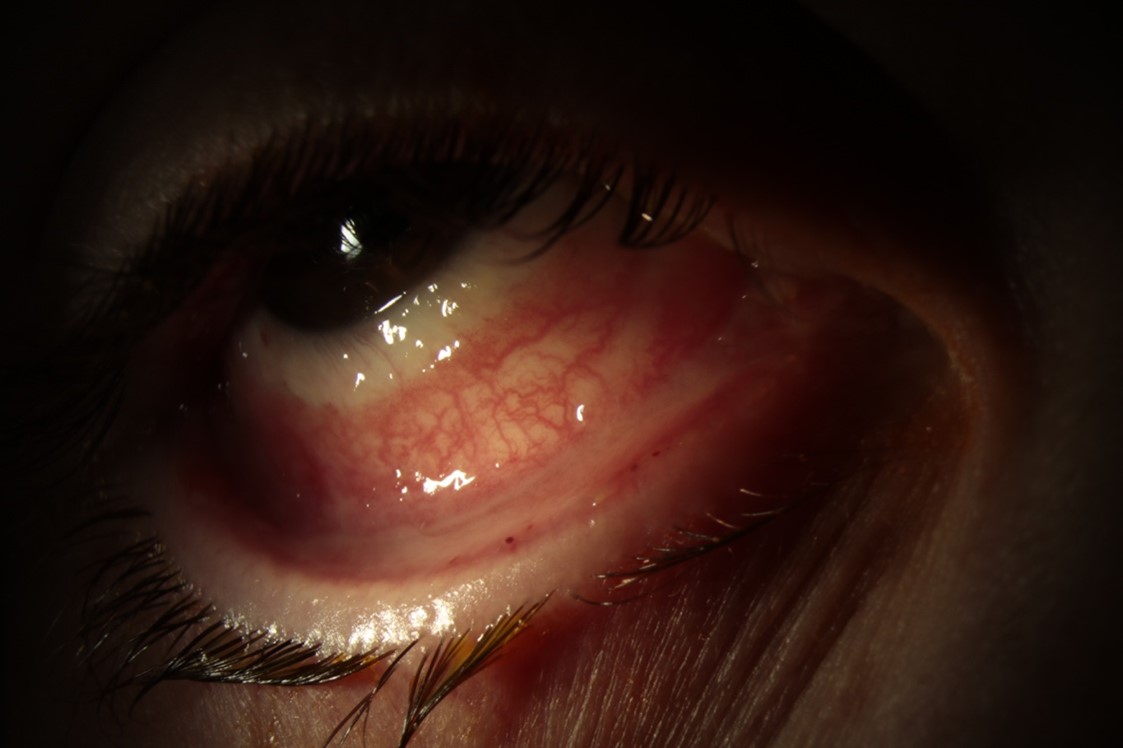 Isolated ocular Stevens-Johnson syndrome – An unusual case of ...