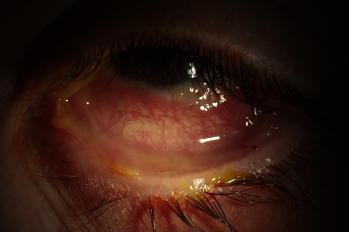 Isolated ocular Stevens-Johnson syndrome – An unusual case of ...